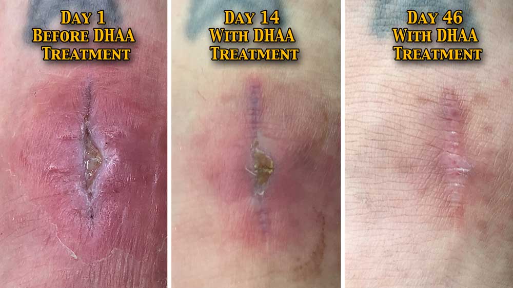 What Causes Wound Infection After Surgery Infoupdate